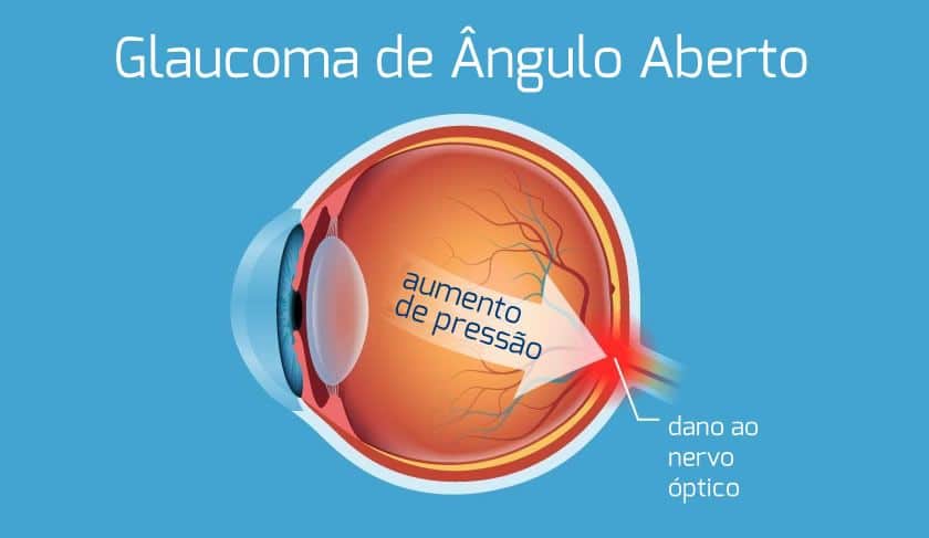 Conheça os tipos de Glaucoma - Dra. Rosimeire Christov